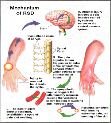 Spine Center of Texas: Reflex Sympathetic Dystrophy & Post Herpetic ...