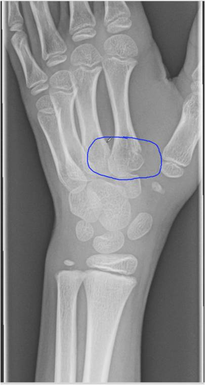 Pseudoepiphysis Index Finger Metacarpal Base - Sumer's Radiology Blog