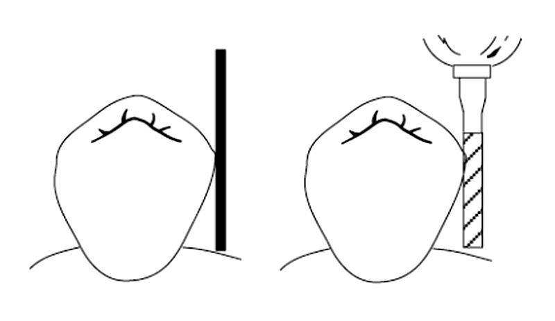 PDF: REMOVABLE PARTIAL DENTURE MANUAL - Surveying, Path of Insertion ...