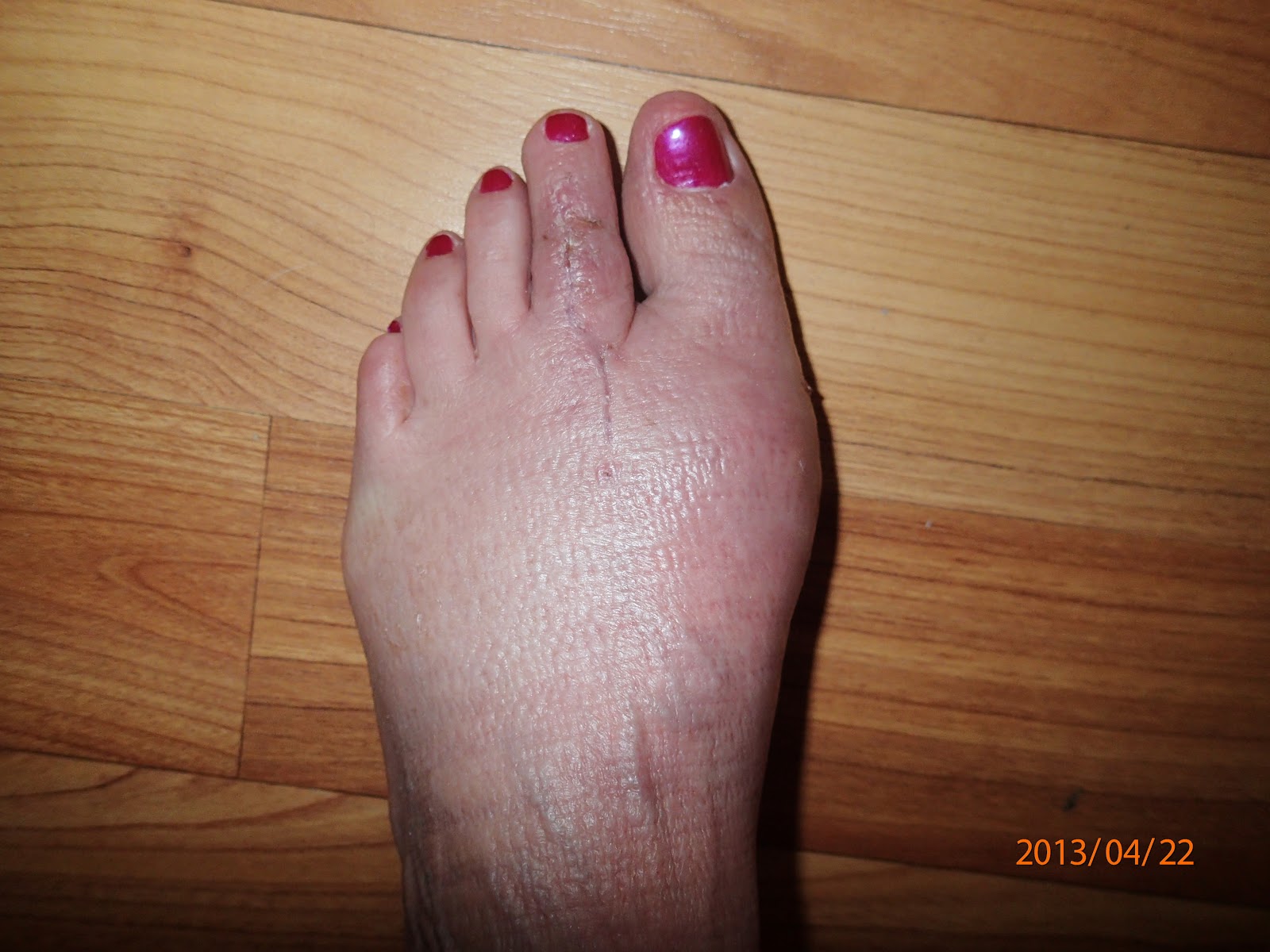 Hammer Toes In Children