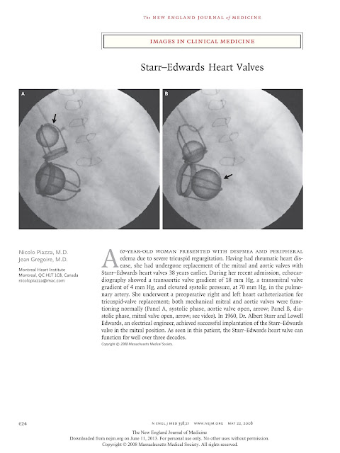 HÌNH ẢNH LÂM SÀNG VÀ CHẨN ĐOÁN HÌNH ẢNH: Starr–Edwards Heart Valves HÌNH ẢNH LÂM SÀNG VÀ CHẨN ĐOÁN HÌNH ẢNH: Starr–Edwards Heart Valves