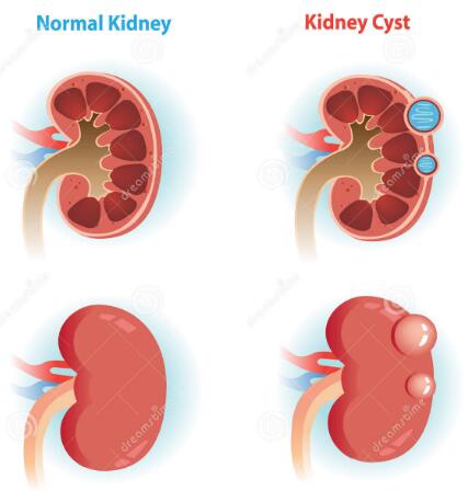 Leczenie PKD: Jak zmniejszyć torbiele w nerce