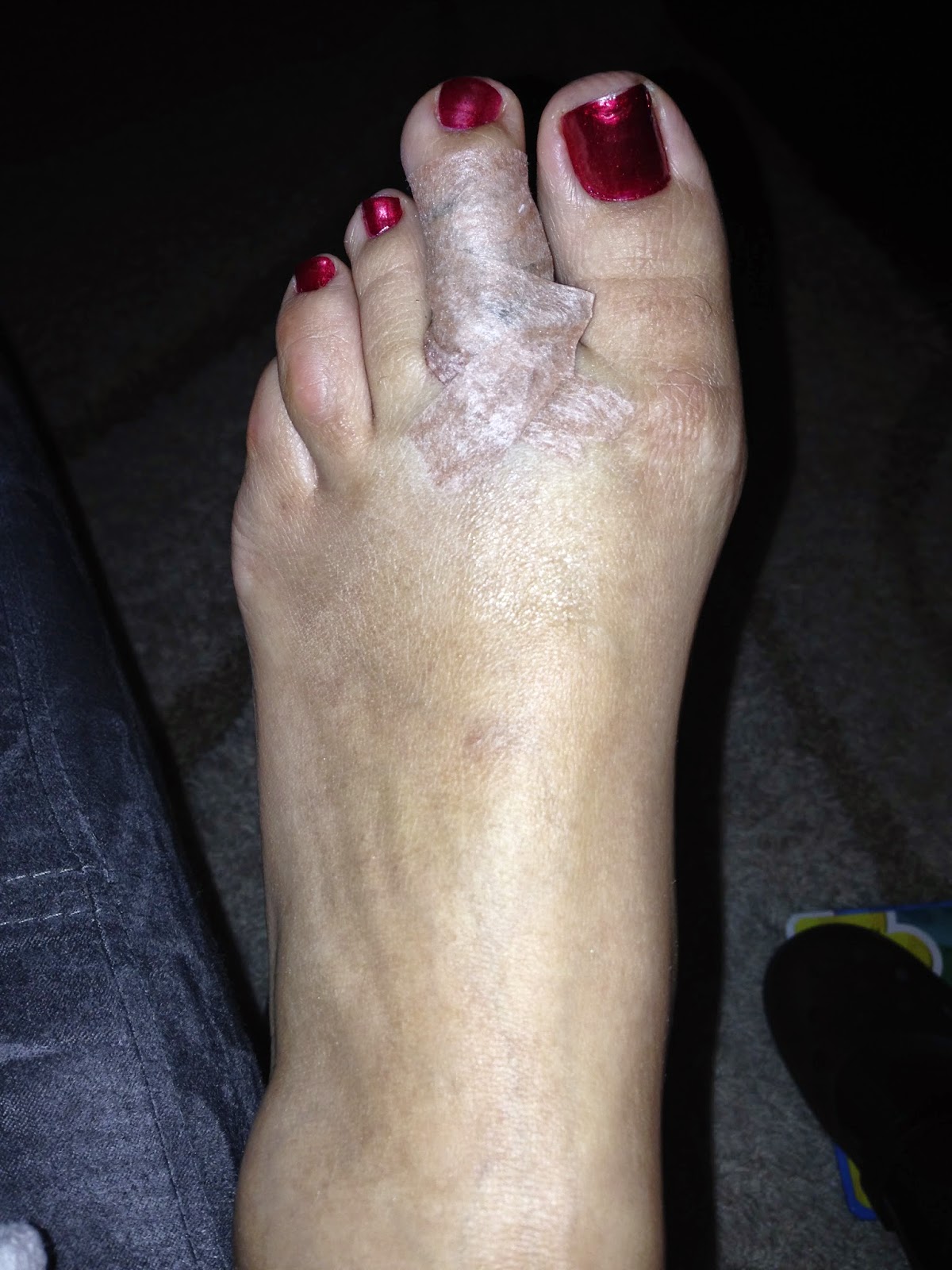 My Toe Shortening Surgery Experience : First Toe, Left Foot!