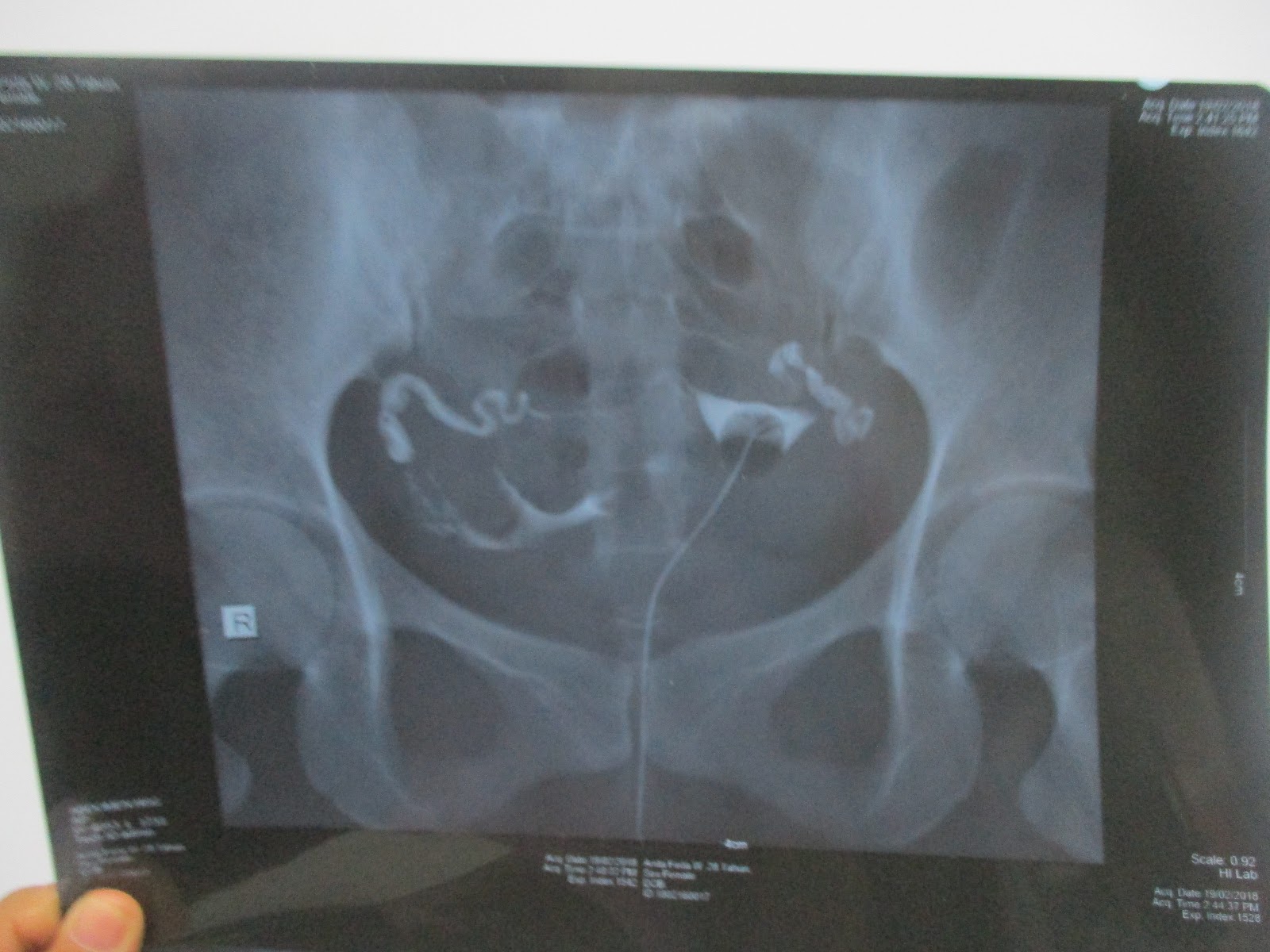 Sharing Pengalaman Melakukan HSG di Hi-Lab Yogyakarta 2018 - Nieta Firda