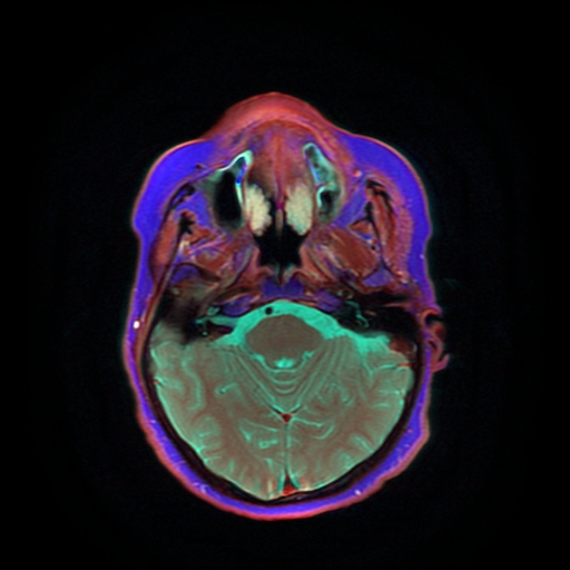 Nevit's blog: Color MRI - Lymphoma of the Neck