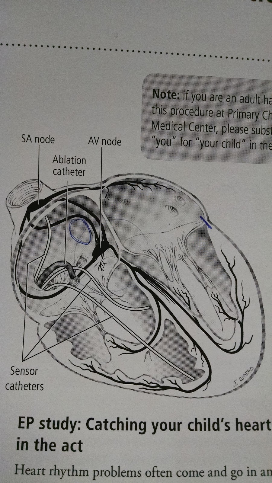 The Story of a Baby with SVT(PJRT)