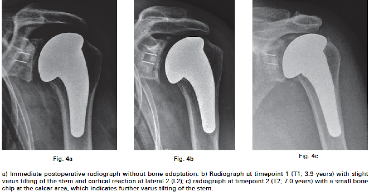 Shoulder Arthritis / Joint Replacement : Total shoulder - is a short ...