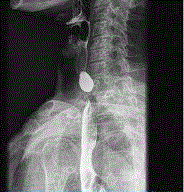 Protocolos De Imagenologia: ESOFAGOGRAMA