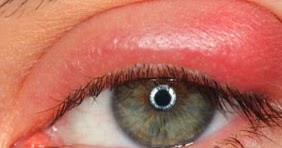 Eyedolatry: Everything You Need to Know About Styes