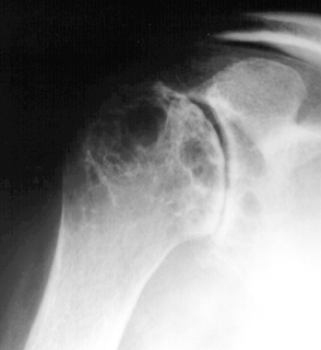 Shoulder Arthritis / Rotator Cuff Tears / Shoulder Pain : Arthritis ...