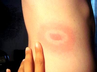 Understanding the Lyme disease Sign and Symptoms | Articles Tips Health