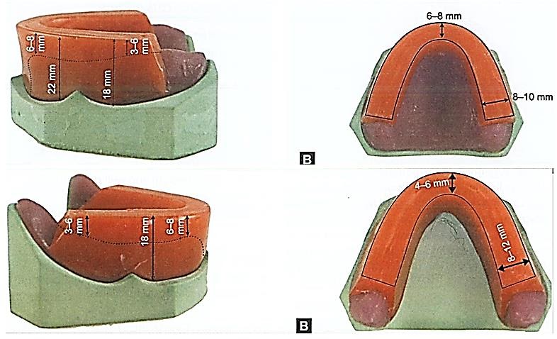 occlusion rim and record base l removable prosthodontics MCQs - WikiDentia