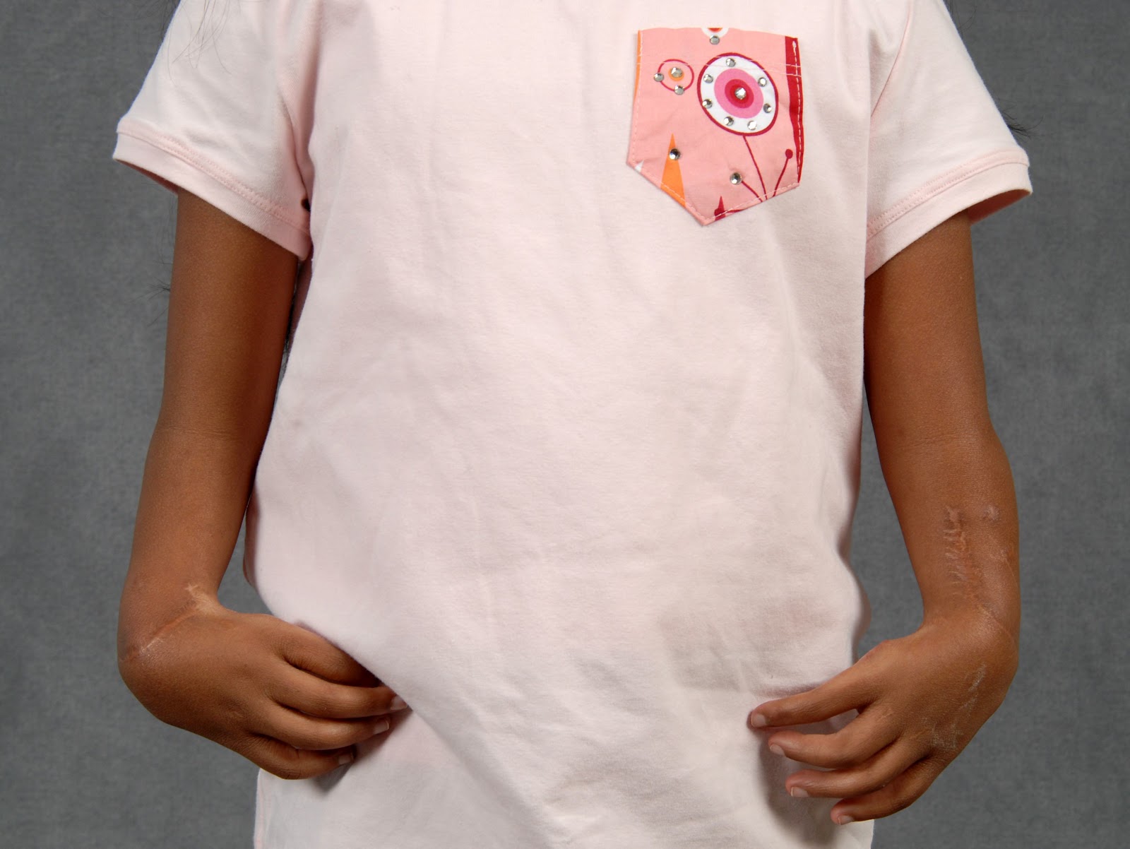 Recurrent Radial Longitudinal Deficiency | Congenital Hand and Arm ...