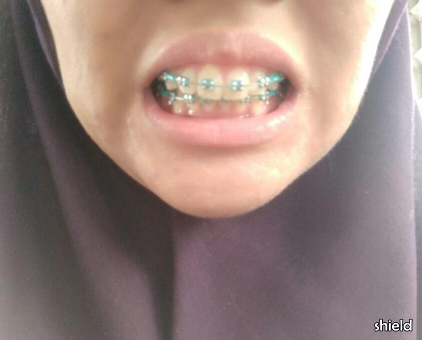 "Peel it. Feel it.": Review Pendakap Gigi: What To Expect?