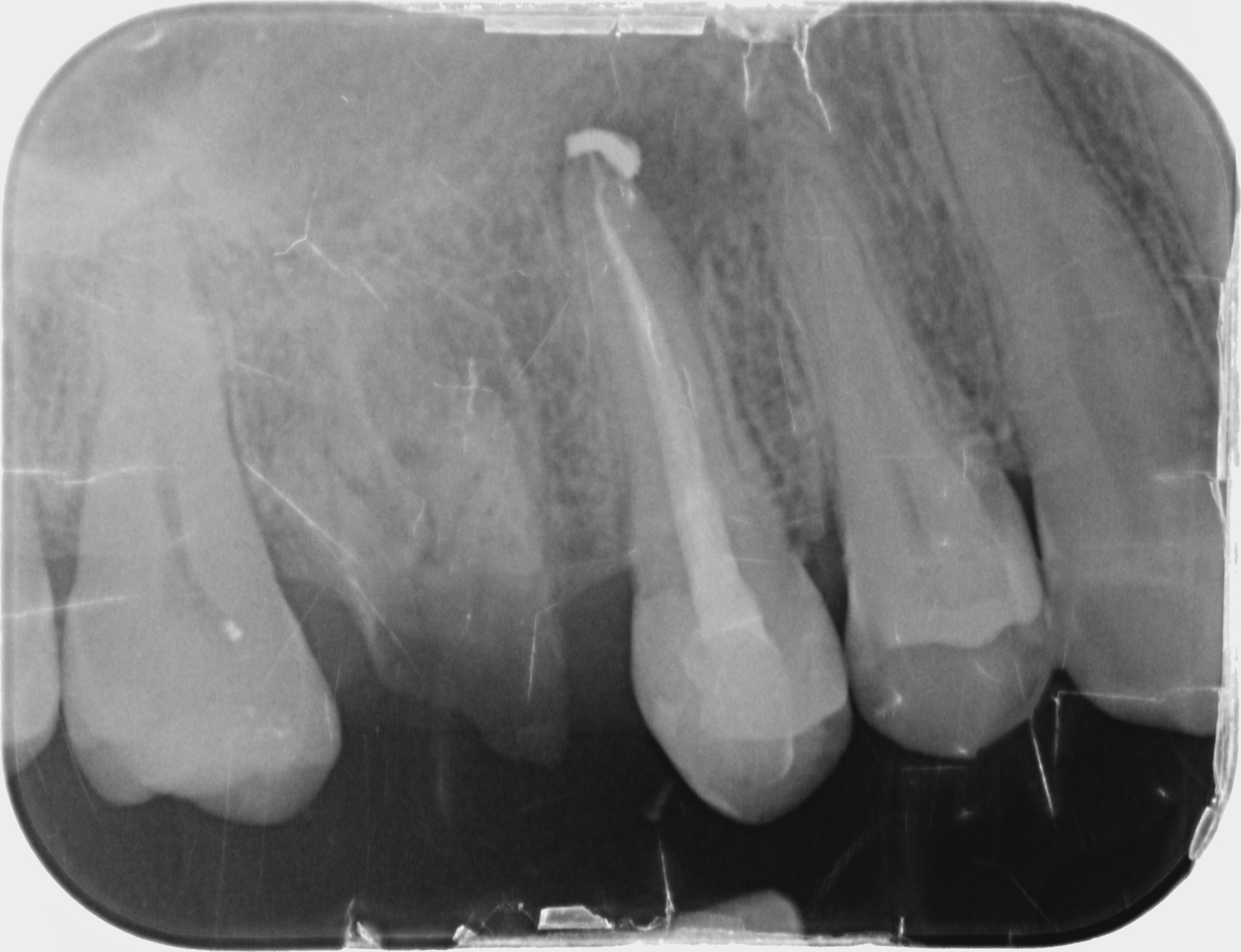 Caso clínico Máster: Necropulpectomía 15