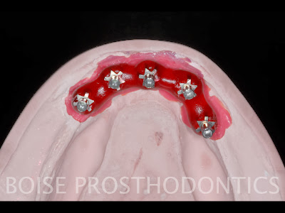 Boise Idaho Prosthodontics: Verification Jig Fabrication for Mandibular ...
