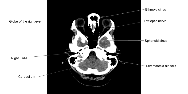 sinaune perawat: Gambaran Normal CT (Computed Tomography) Scaning ...