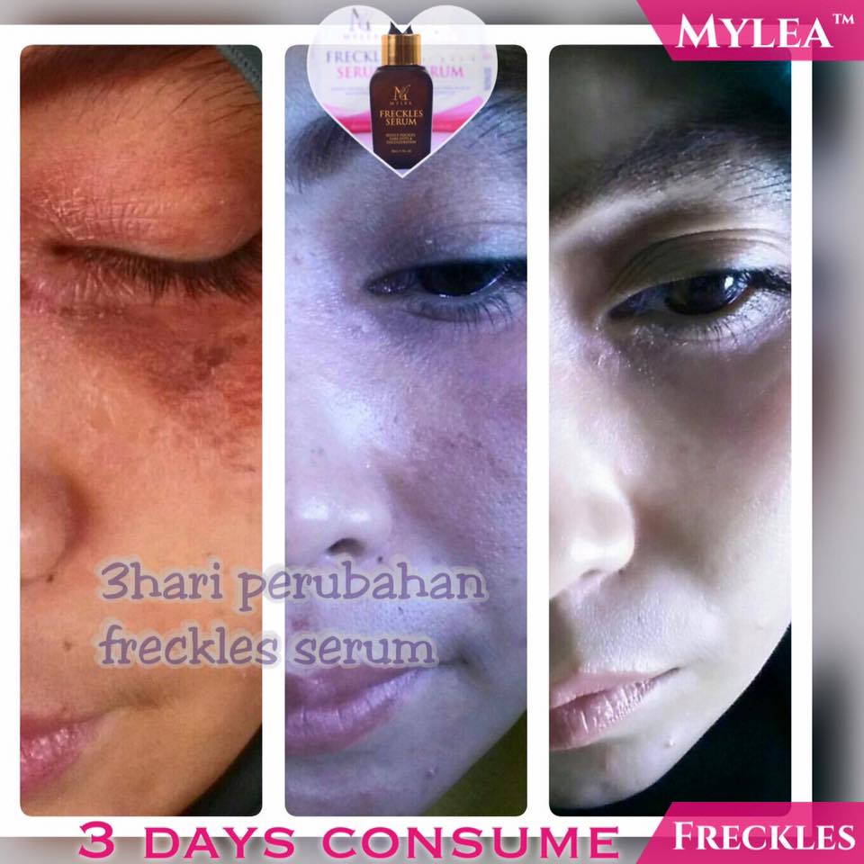 Miss DeL: MYLEA FRECKLES SERUM