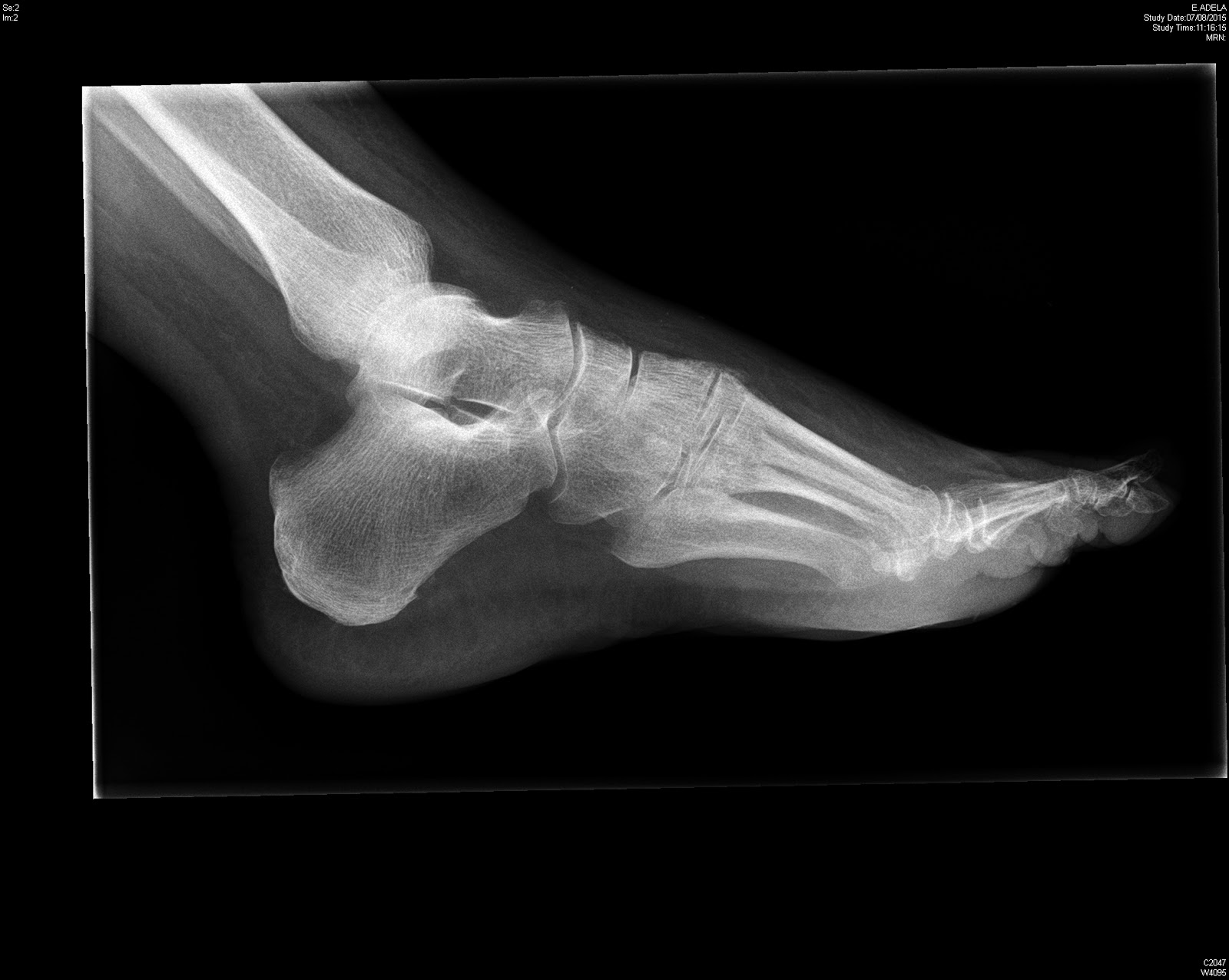 Tecnicos Radiologos: Pie diabético: hallazgos en Diagnóstico por Imagen ...