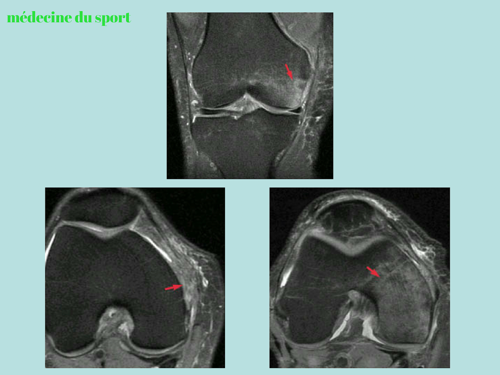 IMAGERIE DU GENOU APPLIQUÉE A LA PATHOLOGIE SPORTIVE
