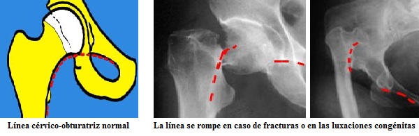 ARTICULACIÓN DE CADERA , ANATOMÍA, FISIOLOGÍA Y PATOLOGÍAS