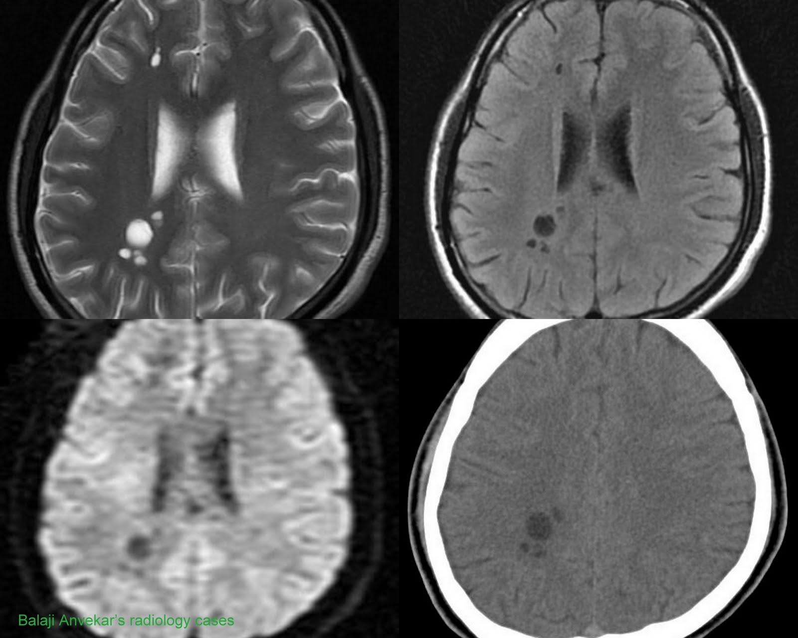 Dr Balaji Anvekar FRCR: Enlarged perivascular spaces