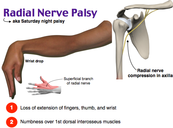 VASTRAL PHYSIOTHERAPY CLINIC: Radial Nerve Palsy And Physiotherapy ...