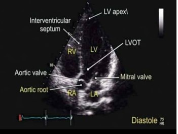 CVT Mohd Farid: Basic Echocardiography:Transthoracic Echocardiography ...