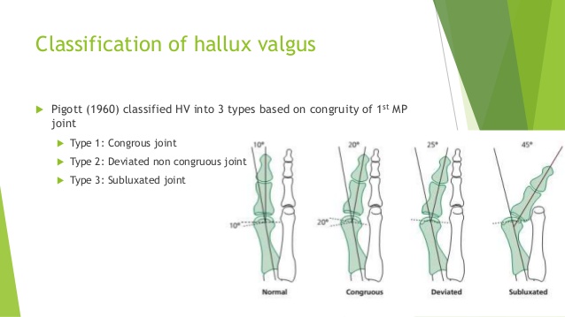 Spine Acupuncture & Hallux Valgus Institute: Βλαισός μέγας δάκτυλος ...