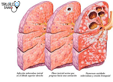 TRUJILLO SANO: TAMBIÉN EXISTEN DISTINTOS TIPOS DE TUBERCULOSIS