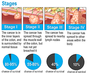 Colon Cancer, Prevention and Solution