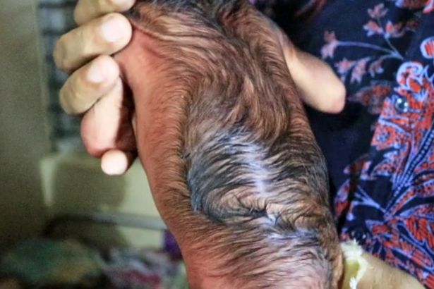 In Pictures: Baby Born With Rare Aging Disease, Progeria In Bangladesh ...