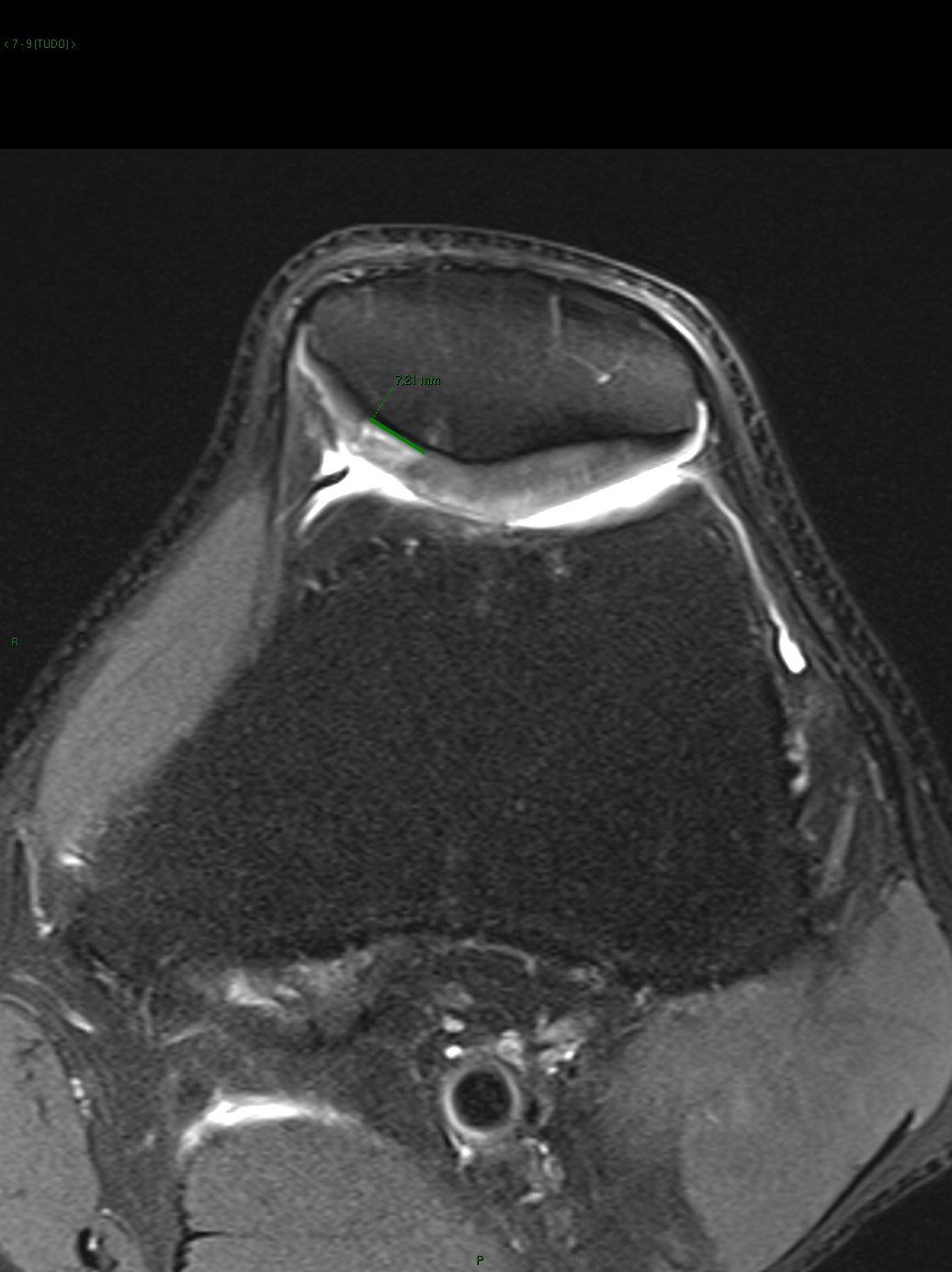 Patellar Condropathy (Condropatia Patelar)
