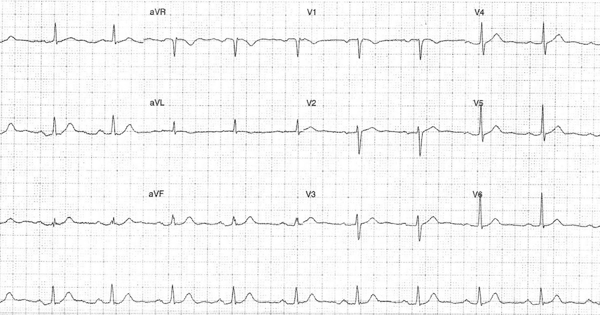 ECG of the Week: ECG of the Week - 26th February 2018 - Interpretation