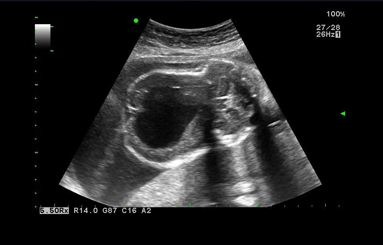 Cloverleaf Skull Ultrasound