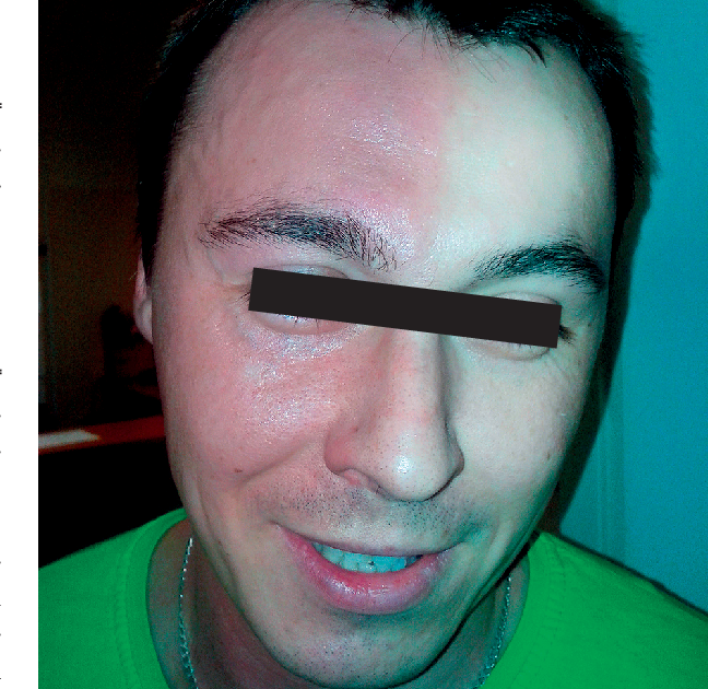 Harlequin Syndrome, Diagnosis, Symptoms and Treatment