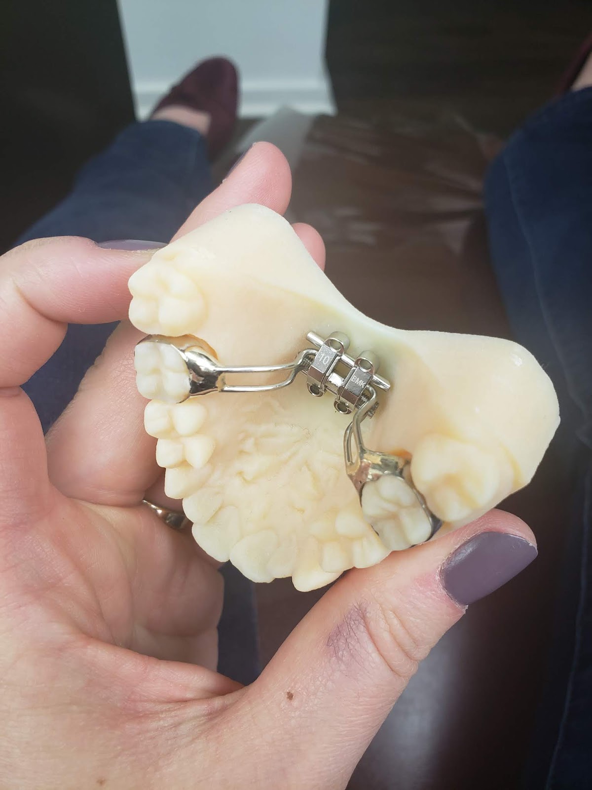 My experience with the MSE (maxillary skeletal expander): July 2019