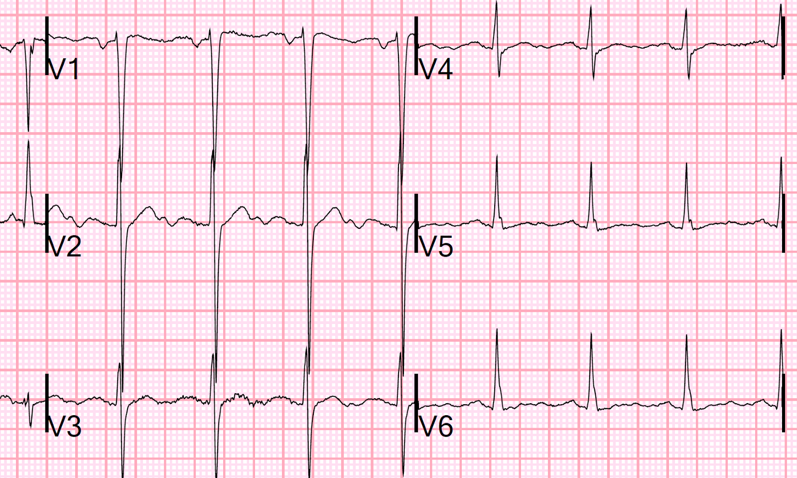 Hypocalcemia Ecg