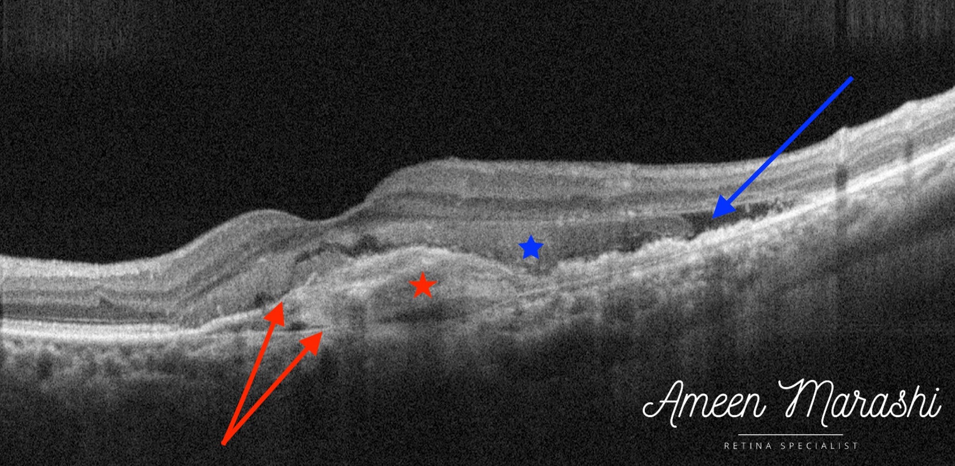 Subretinal hemorrhage case report