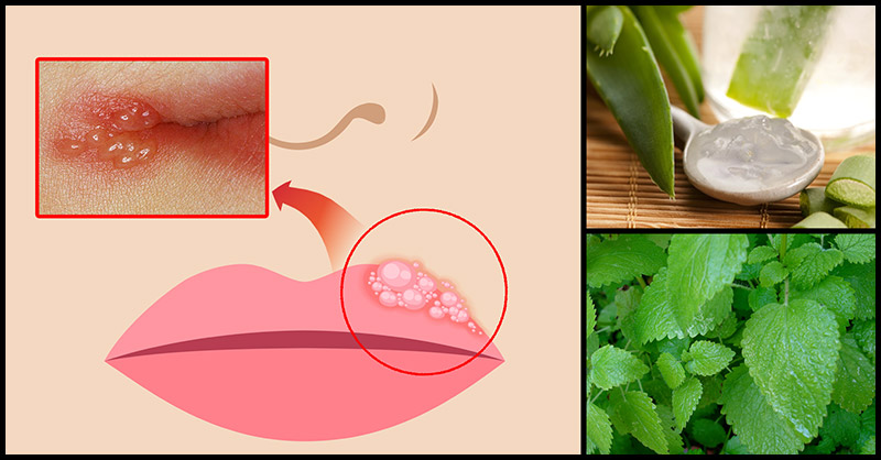 Natural Remedies For Cold Sores | Dr Farrah MD