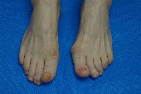 Central Massachusetts Podiatry: Hallux Limitus (a.k.a. Arthritis of the ...