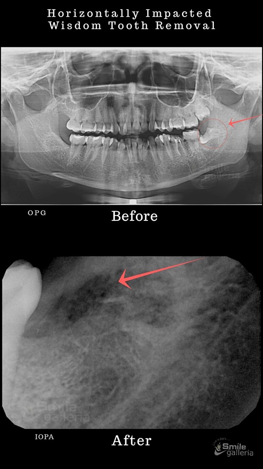 Smile Galleria : Horizontally Impacted Wisdom Tooth Removal Procedure ...