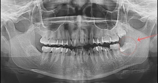 Smile Galleria : Horizontally Impacted Wisdom Tooth Removal Procedure ...