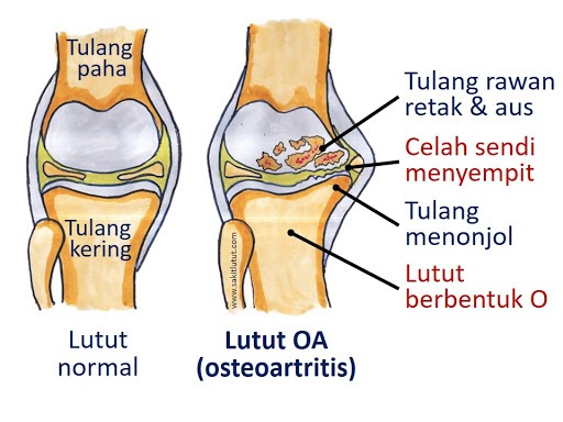 Pengobatan Osteoarthritis pada sendi lutut dengan Alga Series - Konsep ...