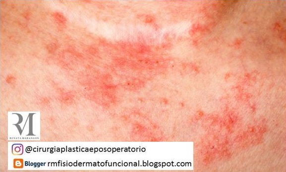 Fisioterapia em Pós Operatório de Cirurgias Plásticas