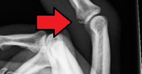 Avulsion Fracture - Treatment | Symptoms | Surgery | Healing