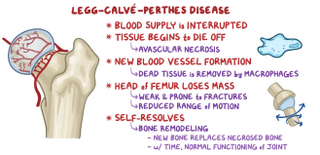 Legg Calve Perthes disease stages, diagnosis, treatment, surgery ...