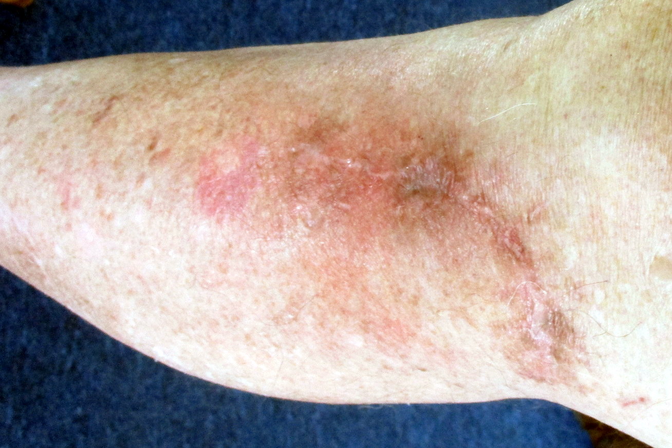 Jayaruh's Blog: Leg Infection
