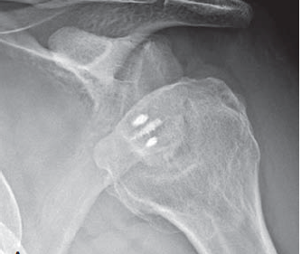 UW Shoulder and Elbow Academy: Humeral head osteotomy in shoulder ...