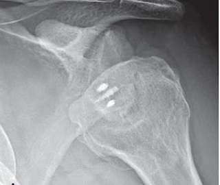 UW Shoulder and Elbow Academy: Humeral head osteotomy in shoulder ...